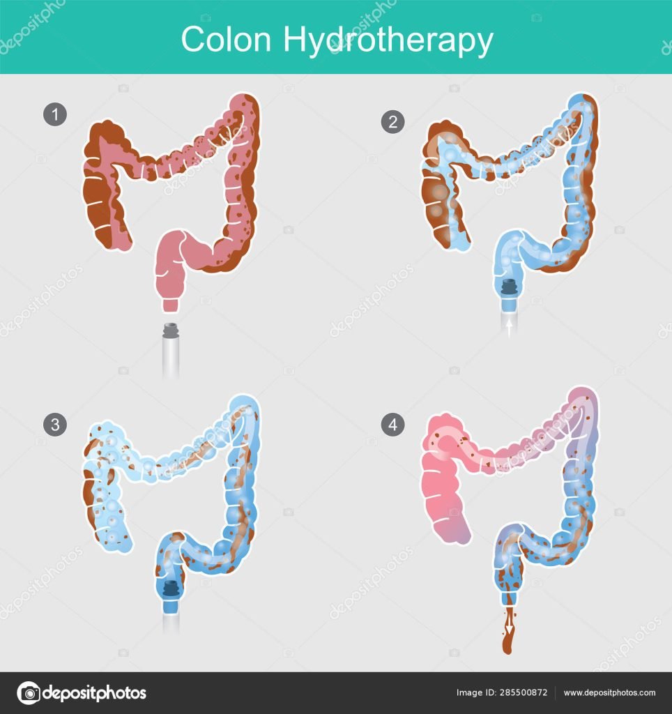 What Is Hydrotherapy Colon Cleansing? – Colonhydrotherapydevice.com